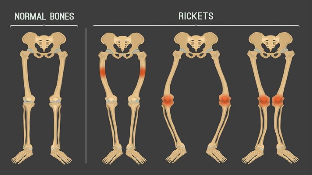 Rickets Symptoms Causes Treatment Medicine Rickets Symptoms Causes Treatment Medicine
