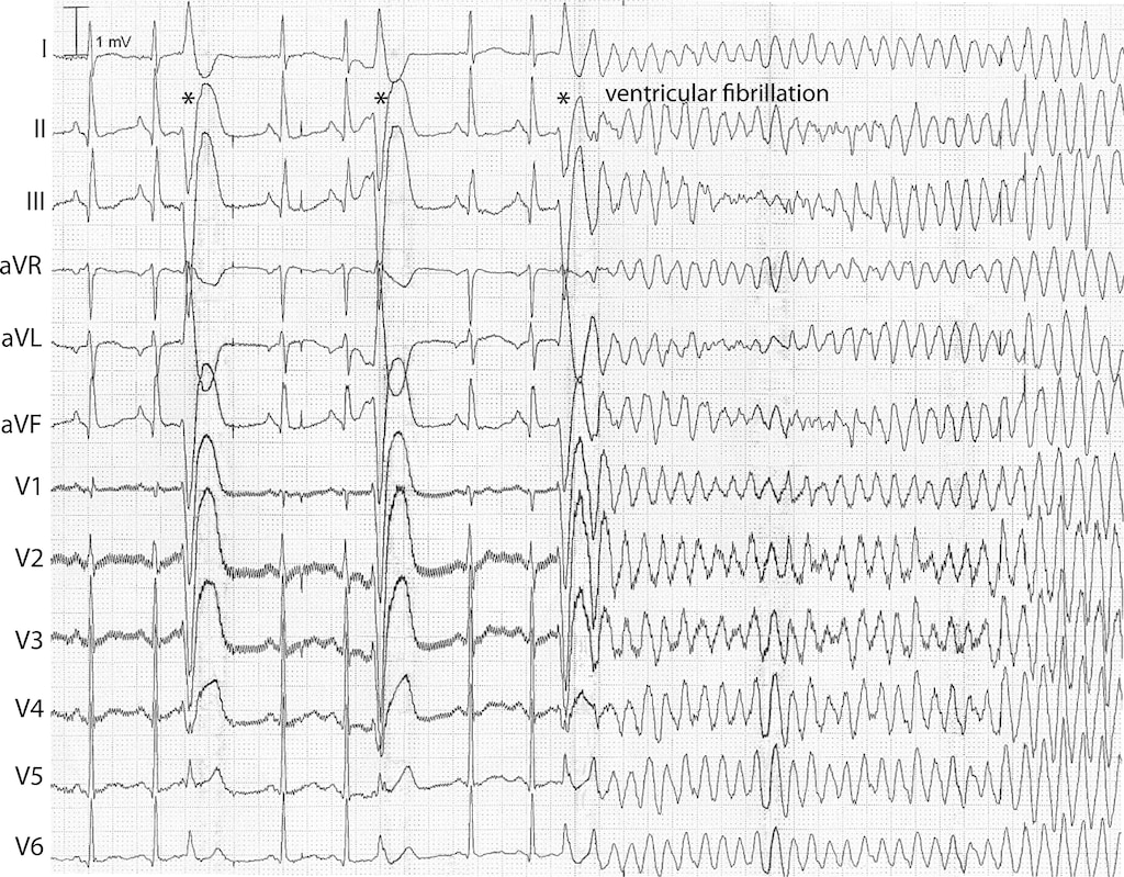 Ventricular Fibrillation - Heart and Blood Vessel Disorders - Medicine.com