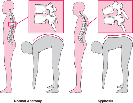 Kyphosis - Children's Health Issues - Medicine.com